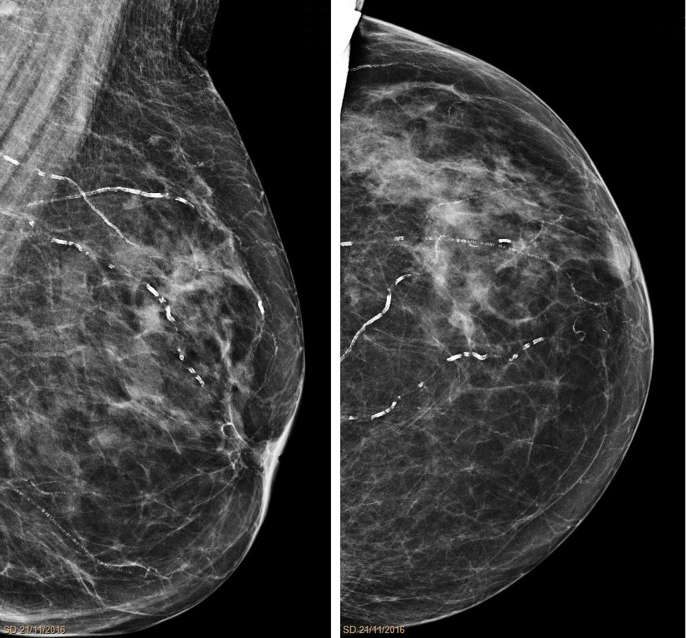 Researchers take issue with study evaluating an AI system for breast ...
